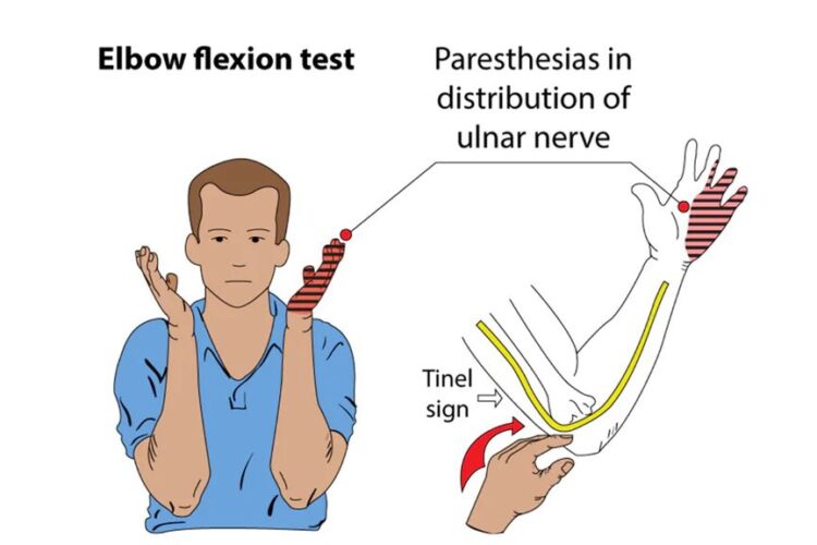 La Prueba de flexión del codo o Elbow Flexion Test - Explicación ...