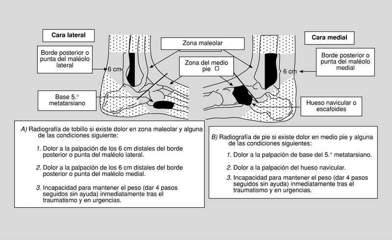 Las Reglas de predicción de fractura de Ottawa o Ottawa Ankle Rules ...