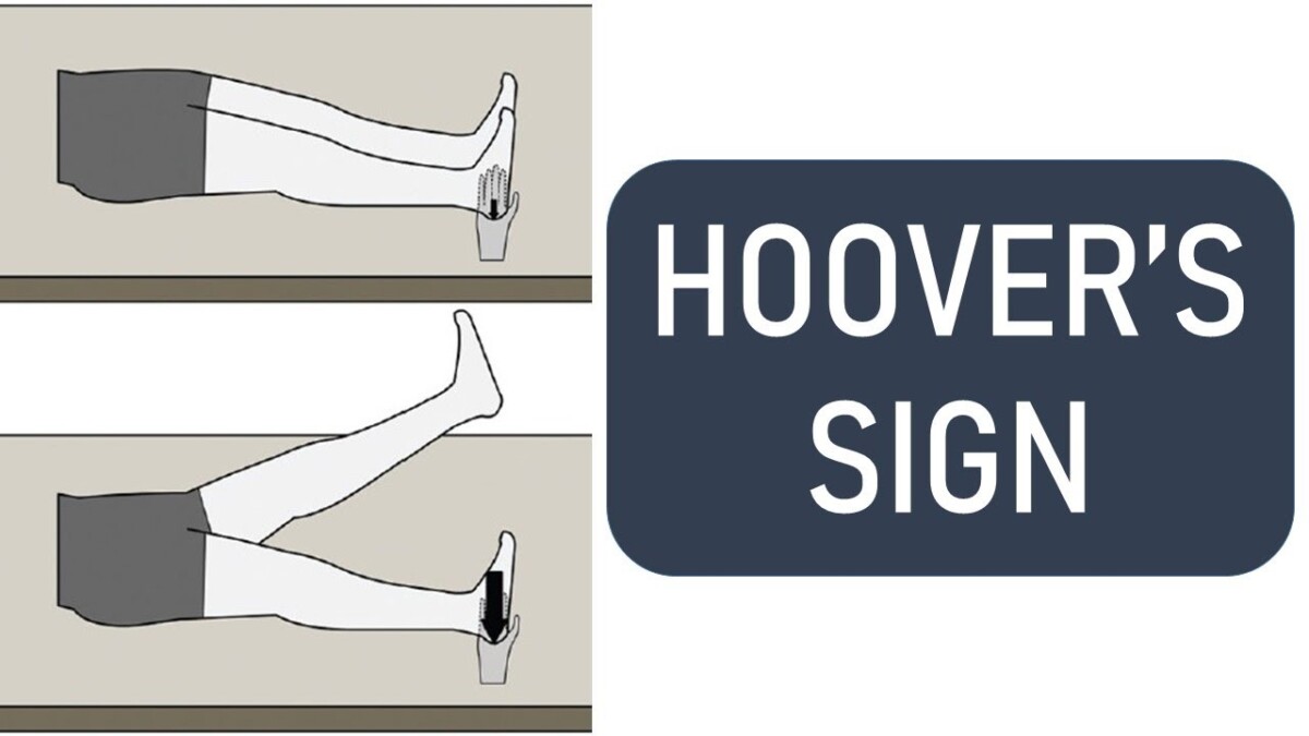 Signo de Hoovers (Leg Paresis) - Explicación completa y detallada ...