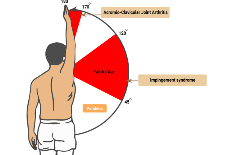 Prueba del Arco Doloroso de hombro (Painful Arc) - Explicación completa ...