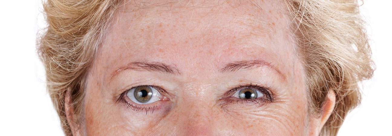 La Escala de valoración de la parálisis supranuclear progresiva (PSP-RS ...