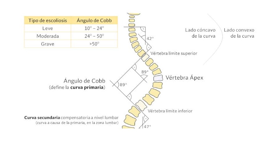 El ángulo De Cobb Análisis Completo Recursos De Fisioterapia